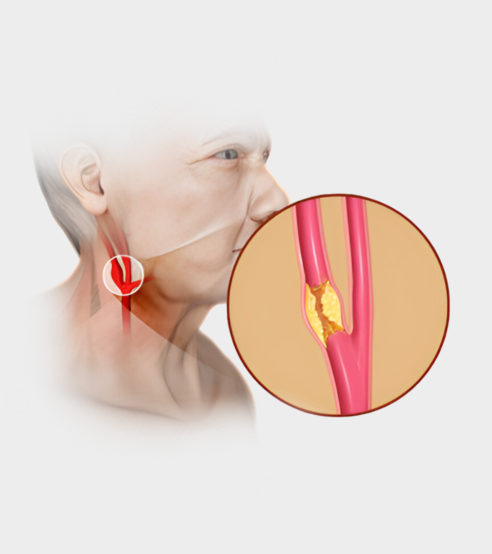 ESTENOSE DE CARÓTIDAS - Dr Daniel Vasconcelos